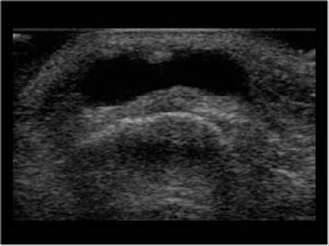 Musculoskeletal Joints And Tendons 66 Knee Case 6610 Bursa And