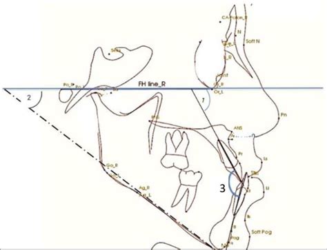 Dental Angular Measurements 1 Ui To Fh 2 Mpa 3 Interincisal Angle