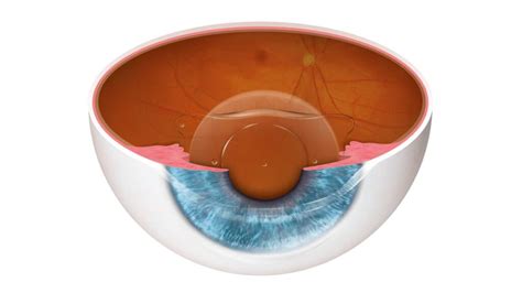 Looking For Icl Surgery In London Trust Expert Ophthalmologists