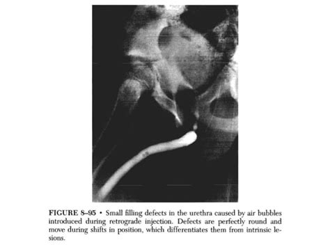 Retrograde Urethrogram Presentation 1 Ppt Pptx