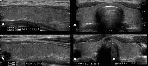 Thyroid The Common Vein
