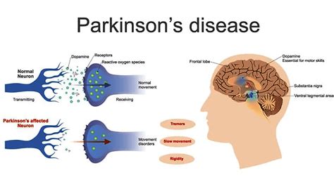 Dopamine Receptors Parkinsons Disease