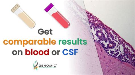 Genomic Testing Cooperative On Linkedin Csf Rna Glioblastoma