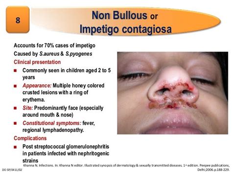 Superficial Bacterial Infection