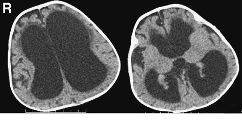 Computed Tomography Scans On Admission Showing Marked Ventricular