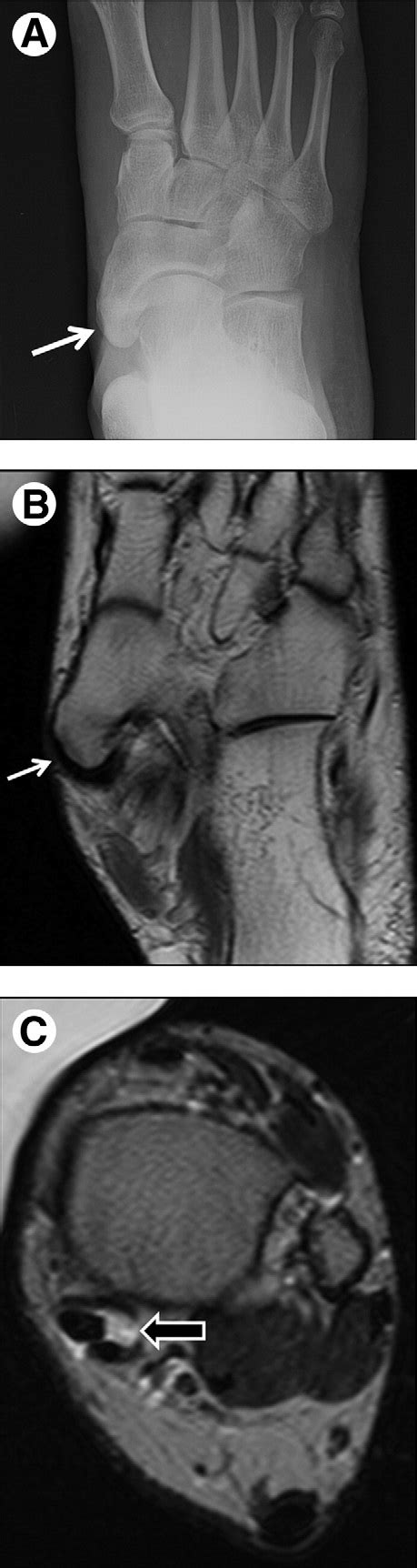 Cornuate Navicular A B Radiograph And Axial Pd Fse Sequence Show Download Scientific