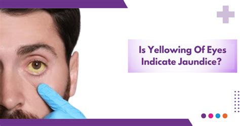 Is Yellowing Of Eyes Indicate Jaundice