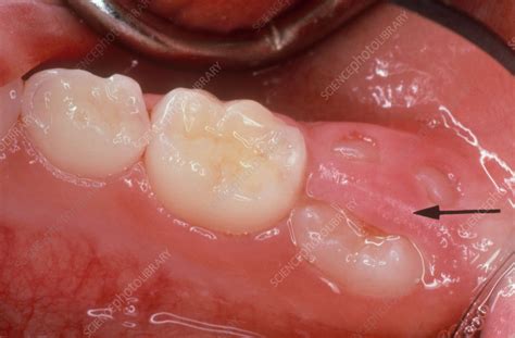 Erupting Molar Stock Image C0584604 Science Photo Library