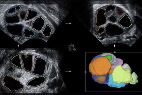 Échographie Gynécologique Et Pelvienne à Paris