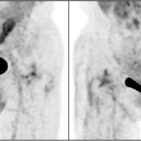 Non Specific Uptake Of ¹⁸f Fluorodeoxyglucose ¹⁸f Fdg By Blood