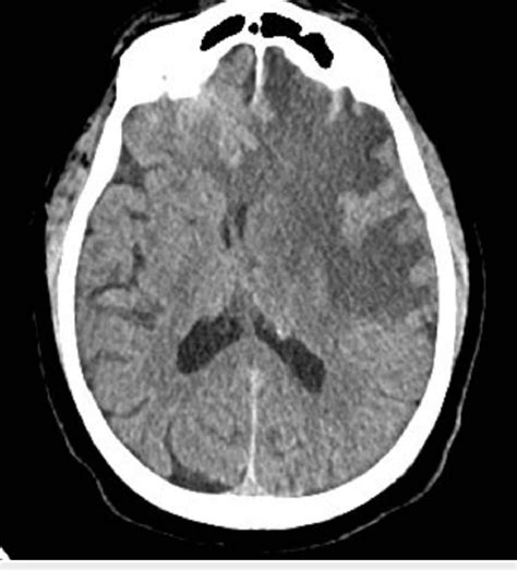 Head Ct Was Done On Presentation Showing Hypo Attenuated Area And Mass