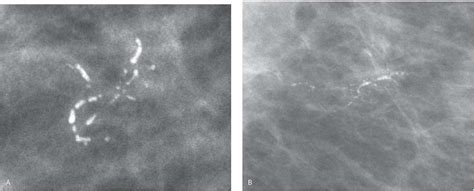 Breast Calcifications Radiology Key