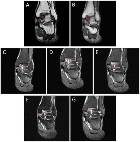 Twelve Year Progression Of Osteochondral Lesions Of The Talus Observed