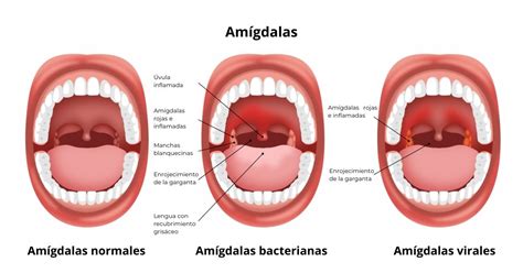 Amigdalitis Causas Síntomas Y Tratamientos Efectivos Discapnet