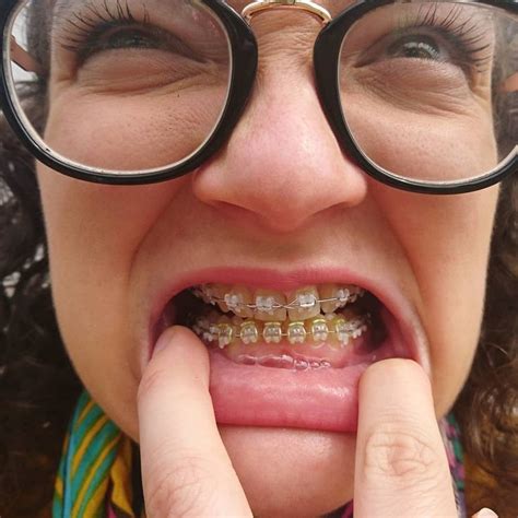 Braces Girlswithbraces Clearbraces Glasses Glassesandbraces
