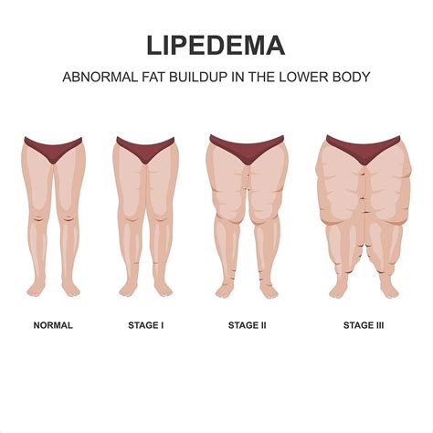 Understanding Lipedema Diagnosis And Treatment In Dubai