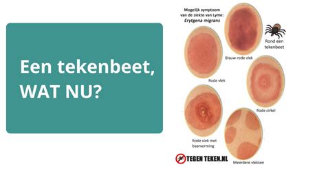 Wat Te Doen Na Een Tekenbeet Lymeherstel