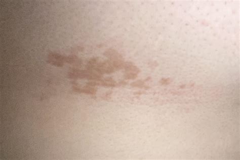 Dark Splotches Under Breasts Rdermatology