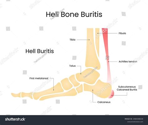 Symptoms Subcutaneous Calcaneal Bursitis Stock Vector Royalty Free 2484348219 Shutterstock