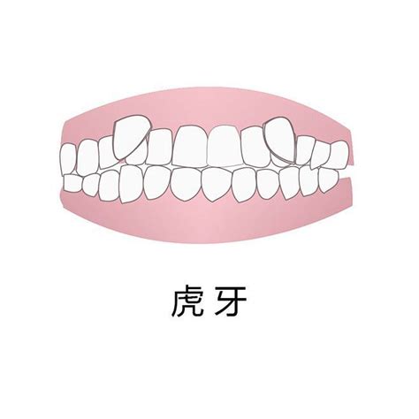 牙齿 口腔 漫画 插画 卡通 牙齿矫正 牙齿疾病 牙齿稀疏 牙齿错乱 反颌 牙列拥挤 中线不齐 开颌 牙齿缺损 深覆合 龅牙 牙齿不齐 偏颌 虎牙 口腔种植 口腔美学正畸 改善龅牙不整齐 对刃