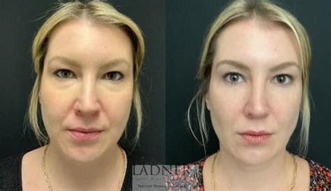 Upper Blepharoplasty Before After