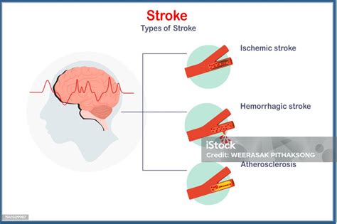 Jenis Stroke Ilustrasi Stok Unduh Gambar Sekarang Strok Perawatan Kesehatan Dan Obat