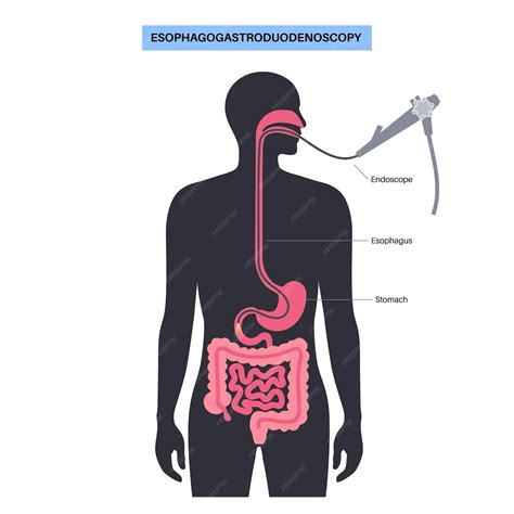 Premium Vector Esophagogastroduodenoscopy Medical Poster Diagnostic