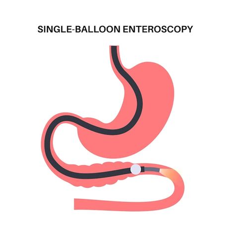 Premium Vector Single Balloon Enteroscopy Procedure Visualization Of