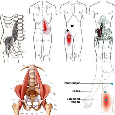 Psoas Pain Referral Pattern