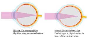 Myopia Management Cargills Opticianscargills Opticians