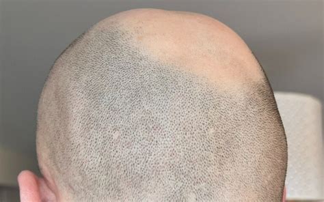Bald On Top Hair On Sides Style Options For 2024