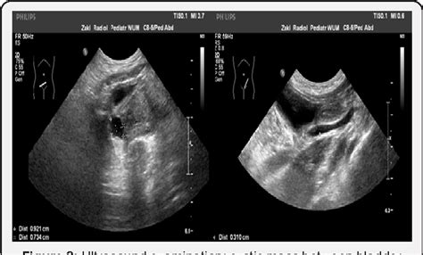Ultrassonografia De Cisto Ductal Gartner Gartner Duct Cyst What Is