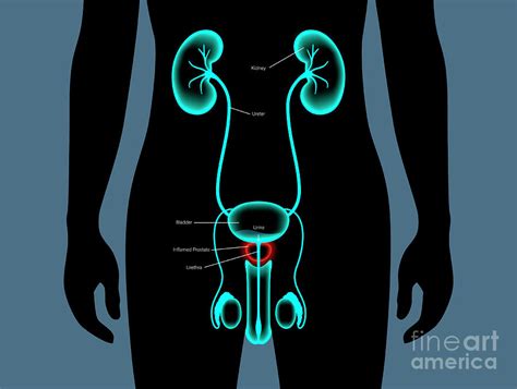 Prostatitis Photograph By Pikovit Science Photo Library Fine Art