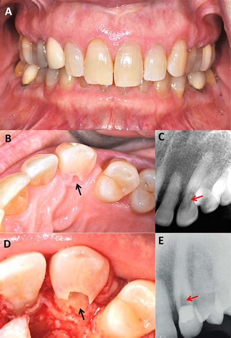 A Familial Pattern Of Multiple Idiopathic Cervical Root Resorption With A 30 Year Follow Up Pmc