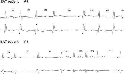 Dynamic Behavior And Autonomic Regulation Of Ectopic Atrial Pacemakers