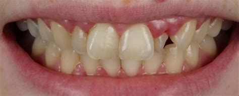 Do You Have To Shave Your Teeth For Veneers Dental Made Easy