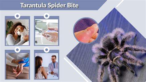 Tarantula Spider Bite Symptoms Treatment And Images