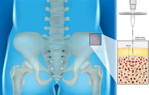 Bone Marrow Pelvis Stock Illustrations 87 Bone Marrow Pelvis Stock Illustrations Vectors