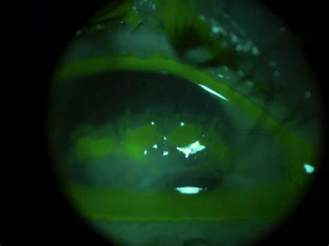 Cornea And Anterior Segment Imaging Epithelial Pooling Vs Staining In Dense Central Band