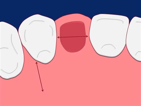Schematic Representation Flap Design The Incision Length Corresponds
