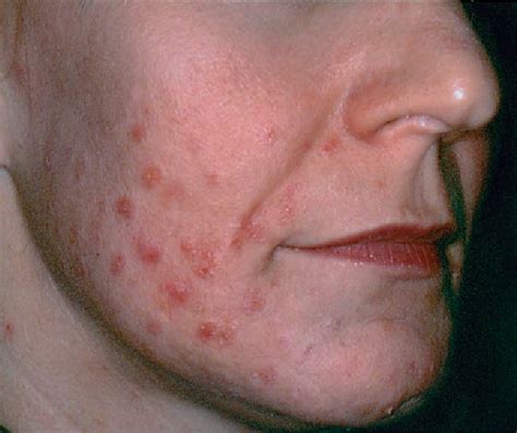 Figure 2 From Sirolimus Induced Acneiform Eruption Semantic Scholar