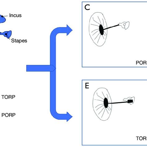 Simplified Schematic Drawing Of Several Situations When Ossicular Download Scientific Diagram