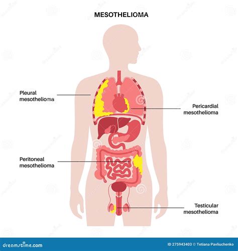 Mesothelioma Tumor Types Stock Vector Illustration Of Tumor 275943403