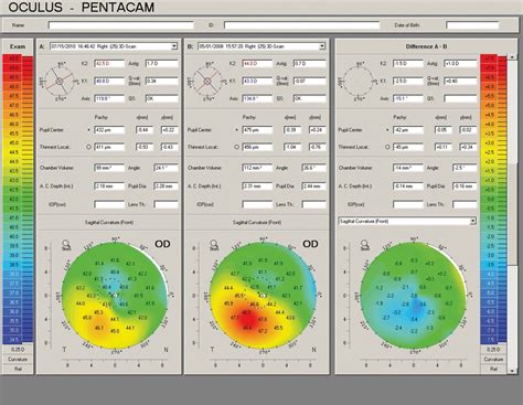 Computerized Corneal Topography Ento Key