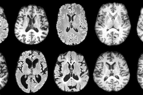 Ai Dementia Tool Slated For Us Trial