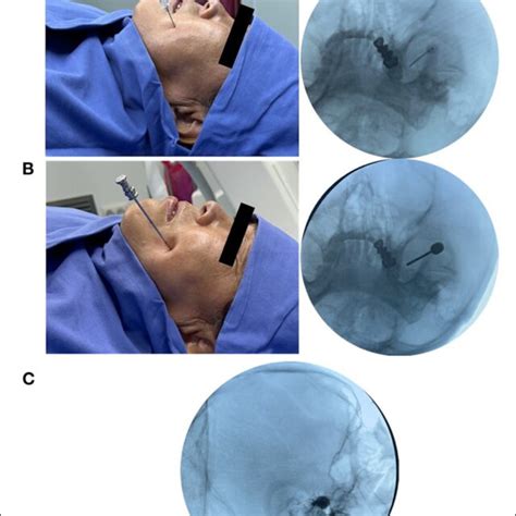 Figure E Percutaneous Balloon Compression Procedure A Local