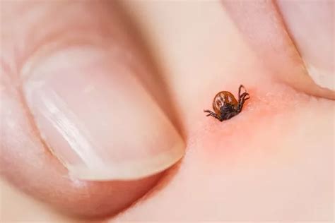 Warning As Lyme Disease Cases Surge In England How To Spot Symptoms