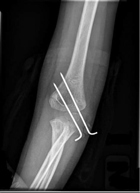 View Of The Pin An Orthopaedic Transformation Journal Of The