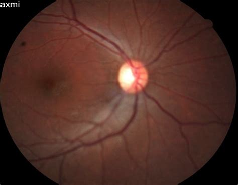 Fundus Picture Showing Temporal Pallor Download Scientific Diagram