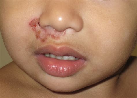 Bacterial Infection Face